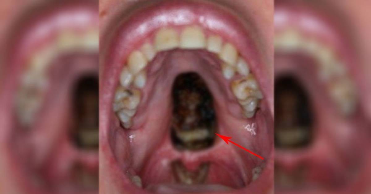 This Shocking Picture Demonstrates How Drugs May Be Gradually Consuming ...