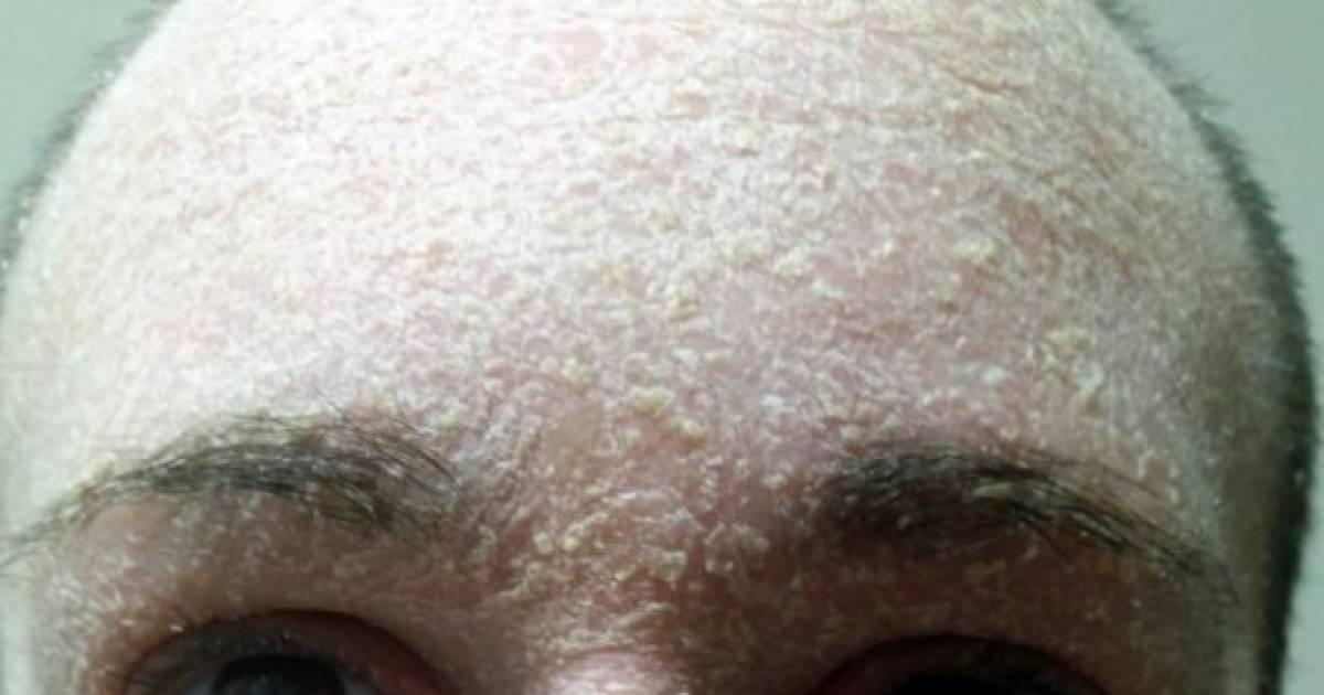 Woman’s Face Falls Off After Stopping Use Of Acne Cream | ThatViralFeed