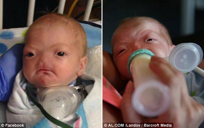 These 3 Kids Who Were Born Without Noses Defied The Odds And Inspired ...