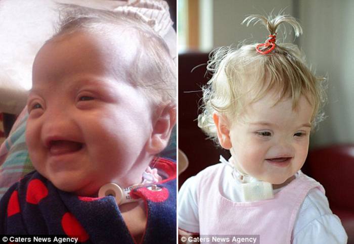 These 3 Kids Who Were Born Without Noses Defied The Odds And Inspired ...