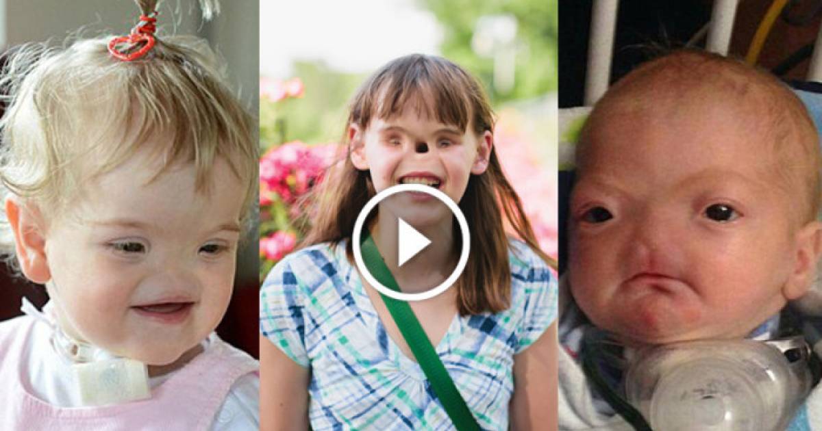 These 3 Kids Who Were Born Without Noses Defied The Odds And Inspired ...