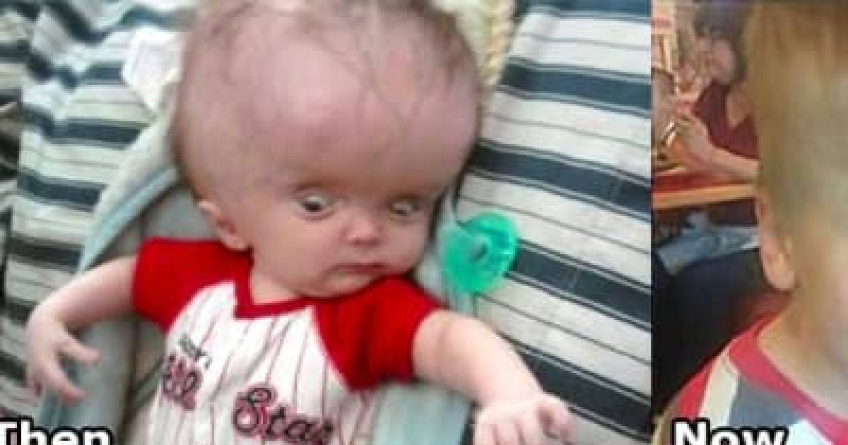 This Baby Was Born With A Swollen Head But Look At Him Now 6 Years ...