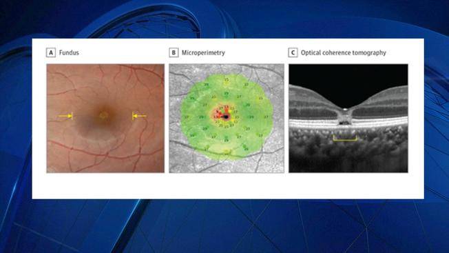 Striking Images Reveal Woman's Eye Damage From Looking At Solar Eclipse ...