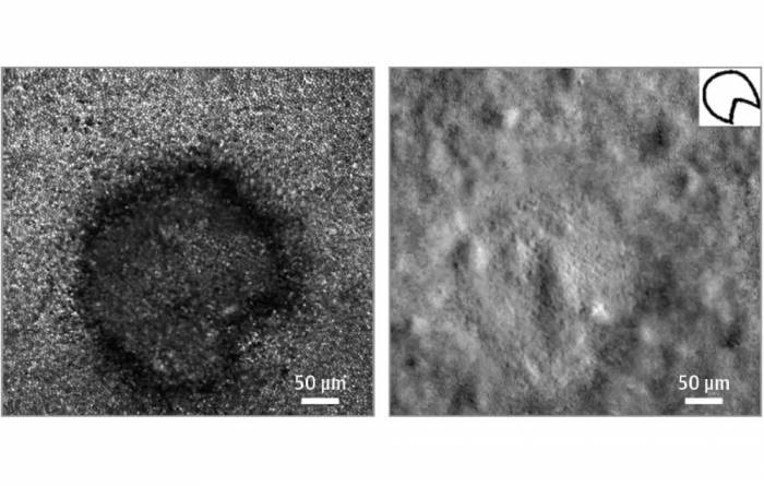 Striking Images Reveal Woman's Eye Damage From Looking At Solar Eclipse ...