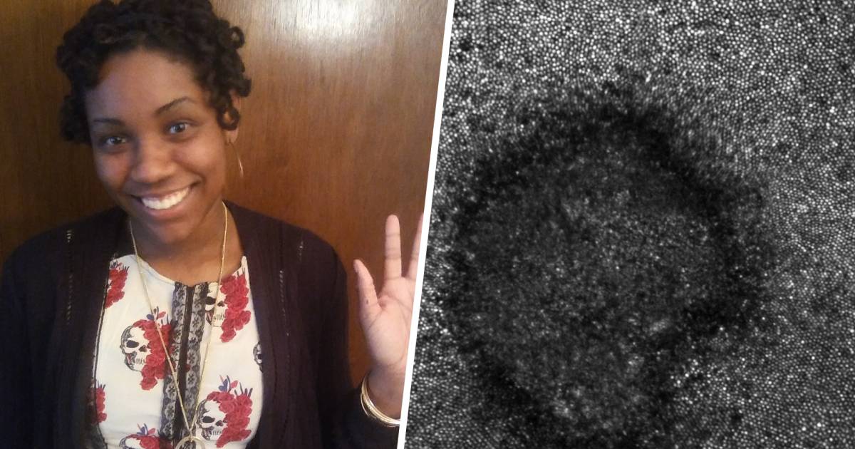 Striking Images Reveal Woman's Eye Damage From Looking At Solar Eclipse ...