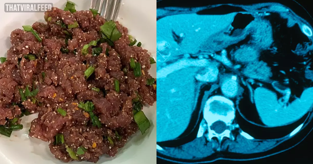 Single Bite Of Koi Pla Thai Dish Can Give You Liver Cancer Warns Doctor ...
