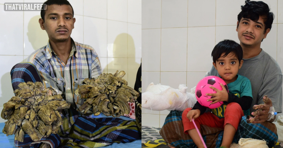 A Man Who Was Called “The Tree Man” Was Able to Hold His Daughter Again ...