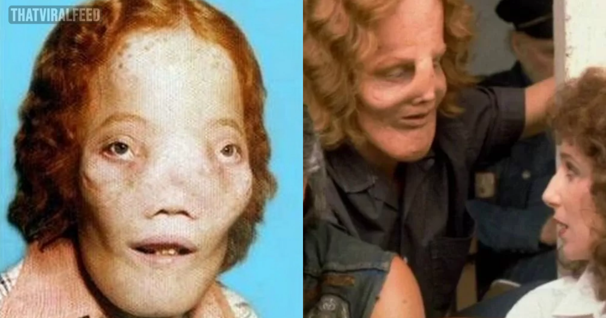 The True Story Of Roy Lee 'Rocky' Dennis Whose 'Rock-Hard' Head Doubled ...