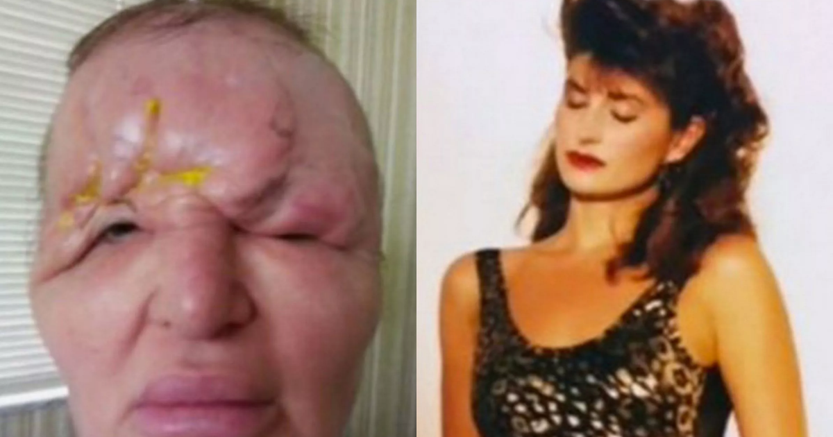 Carol Bryan Left 'Unrecognizable' After Botched Treatment Causes Severe ...